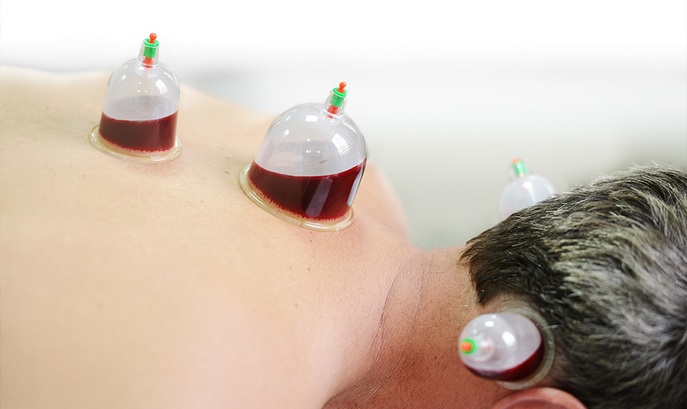 Wet Cupping The Cupping Therapy